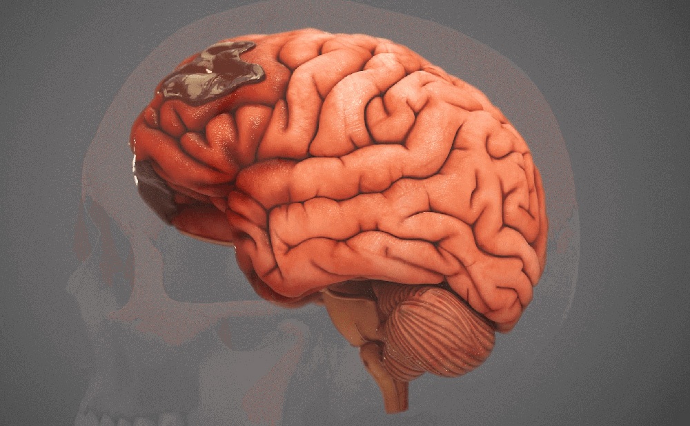 Brain Injury Lawyers in Omaha | Doctors Practicing Law in Nebraska ...